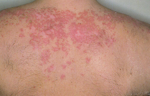 Lupus erythematosus photos and description